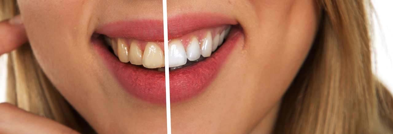 WHITER TEETH? LET’S KNOW ABOUT TEETH WHITEING….