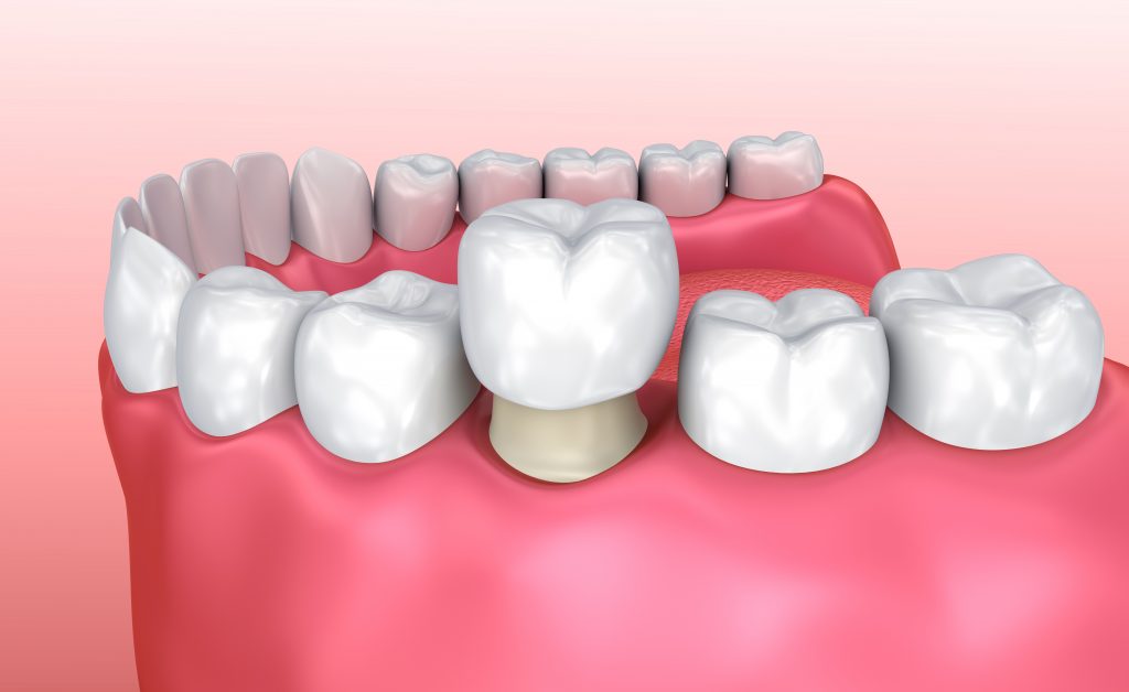 Crowns and Bridges - Clove Dental