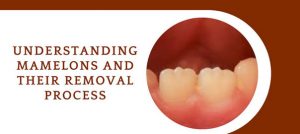Mamelon Teeth | What Are They & How To Remove Them