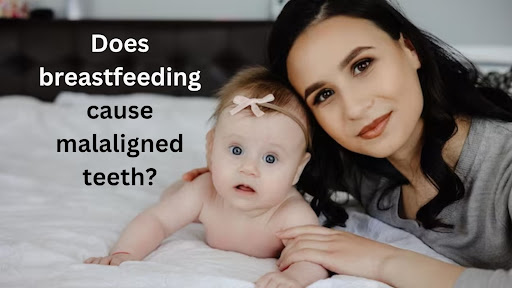 Does breastfeeding cause malaligned teeth?