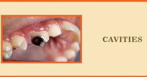 Cavities: Symptoms, Causes, Treatments