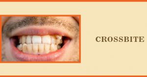 Crossbite Solutions: Uncover Symptoms, Causes & Treatment