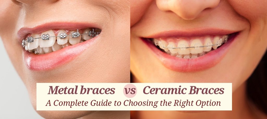 Metal Braces vs. Ceramic Braces: Pros, Cons, and How to Decide