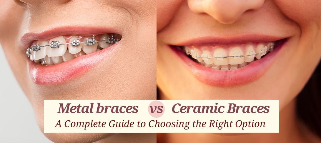 Ceramic Braces Vs Metal Braces Metal Vs Ceramic Braces: Finding Your