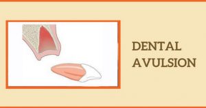 Dental Avulsion - Symptoms, Causes, Treatment