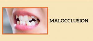 Malocclusion Guide: Symptoms, Causes, Treatments | Clove Dental
