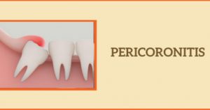 Pericoronitis - Symptoms, Causes & Treatments