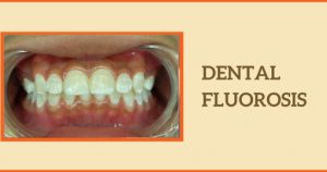 Dental Fluorosis: Symptoms, Causes, Treatments