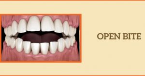 Open Bite - Symptoms, Causes, Treatment