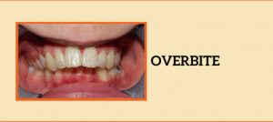 Overbite Issues: Symptoms, Causes, Solutions | Clove Dental