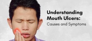 Mouth Ulcers: Causes, Symptoms, and Treatment