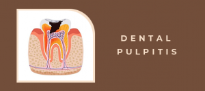Dental Pulpitis Explained: Causes, Symptoms, and Treatments - Clove Dental