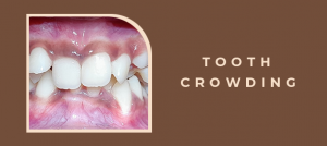 Tooth Crowding: Signs, Causes, and Treatment of Crowded Teeth