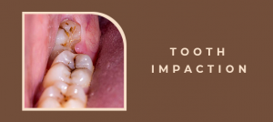 Tooth Impaction: Symptoms, Causes, and Treatment Available