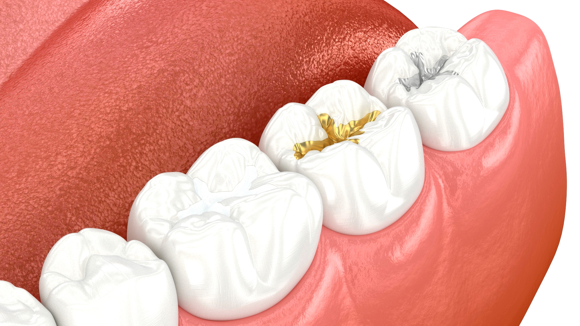 Tooth Filling & Teeth Gap Filling at Affordable Costs