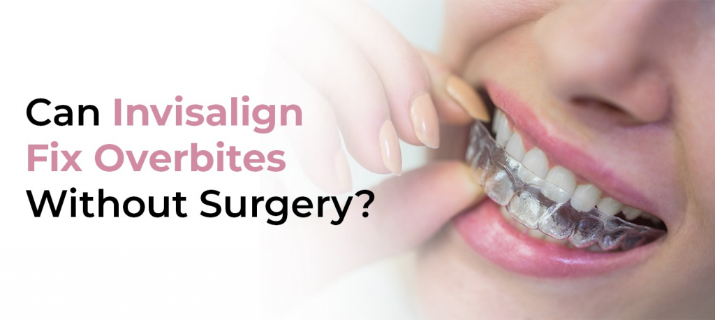 Invisalign Can Fix Overbites Without Surgery!