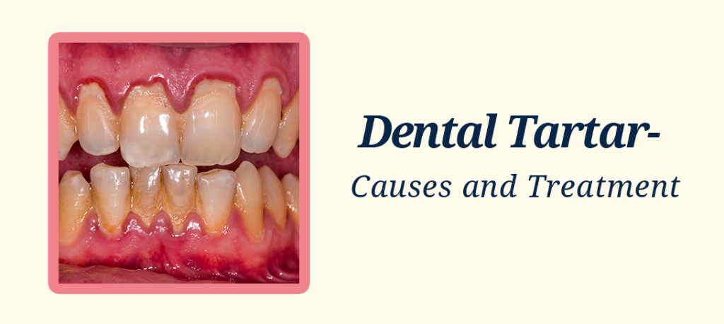 Dental Tartar- Causes, Treatment and How to Remove It Safely