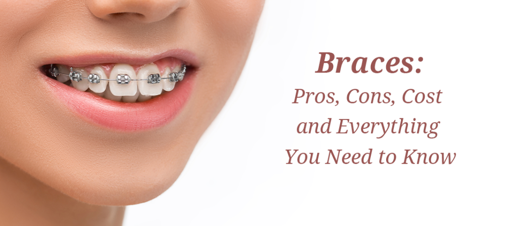 Braces: Pros, Cons, Costs & Types Explained